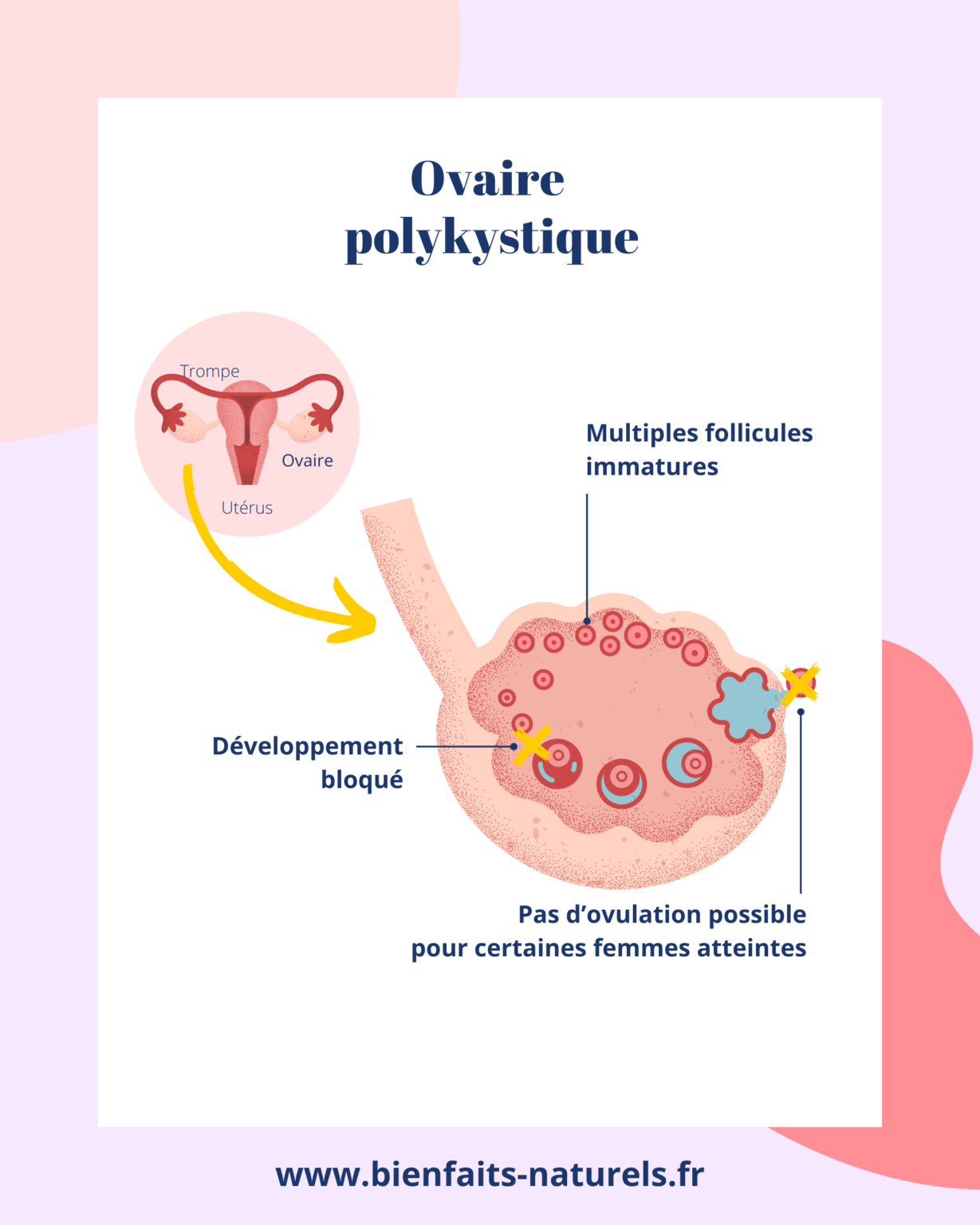 Les symptômes du SOPK